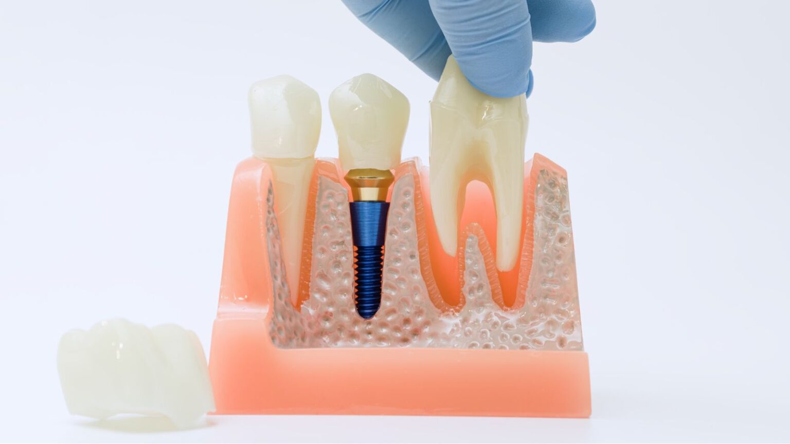 Wisdom Tooth Removal and Future Dental Implant Options: A Clear Guide ...